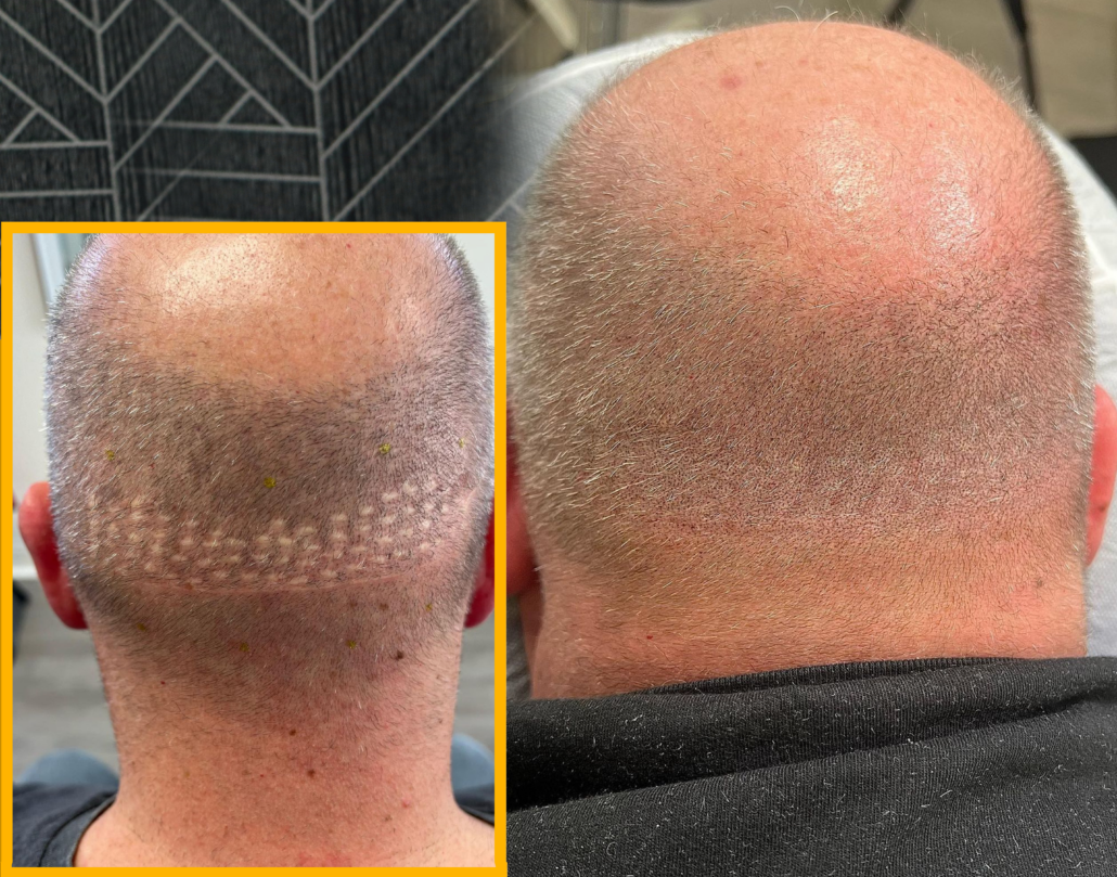 HAIR TRANSPLANT SCARS