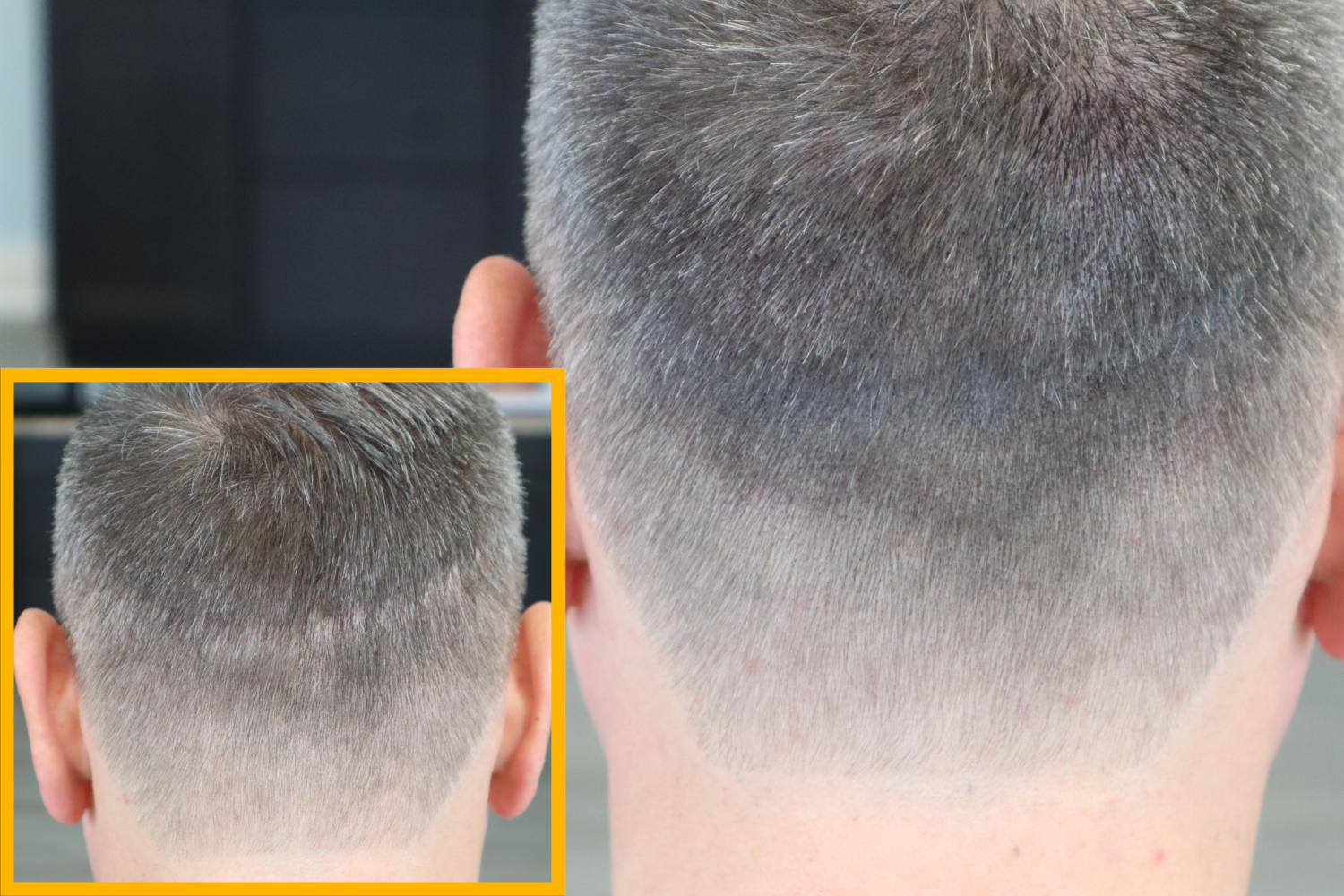 HAIR TRANSPLANT SCARS